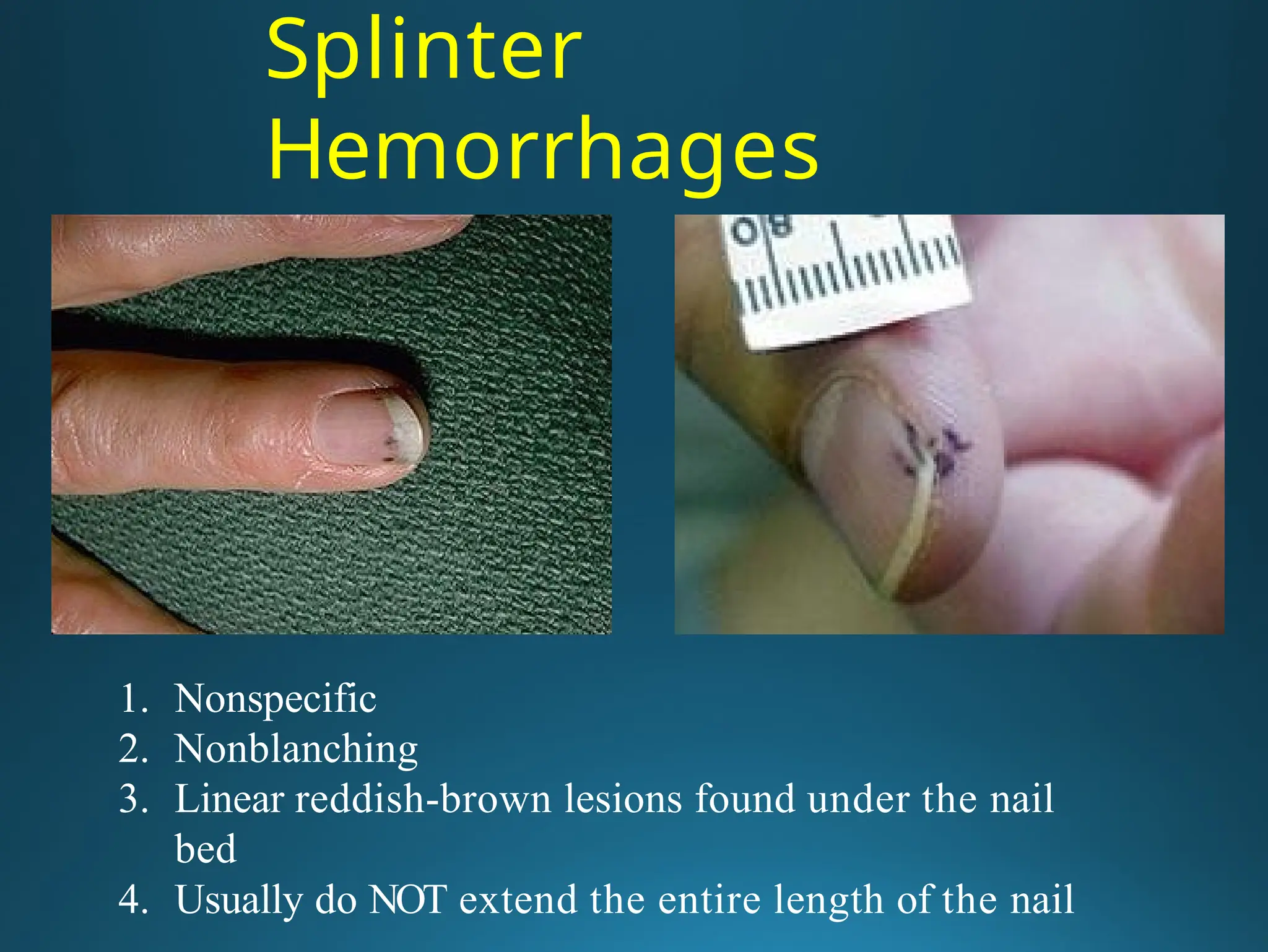 Infective endocarditis Endocrine Causes – Primary Aldosteronism ...