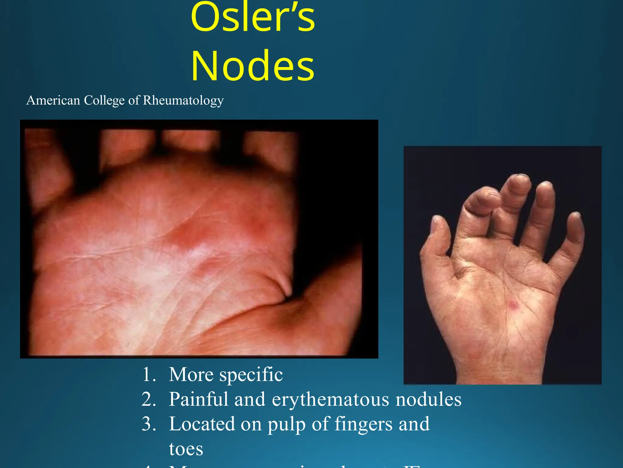 Infective endocarditis Endocrine Causes – Primary Aldosteronism ...