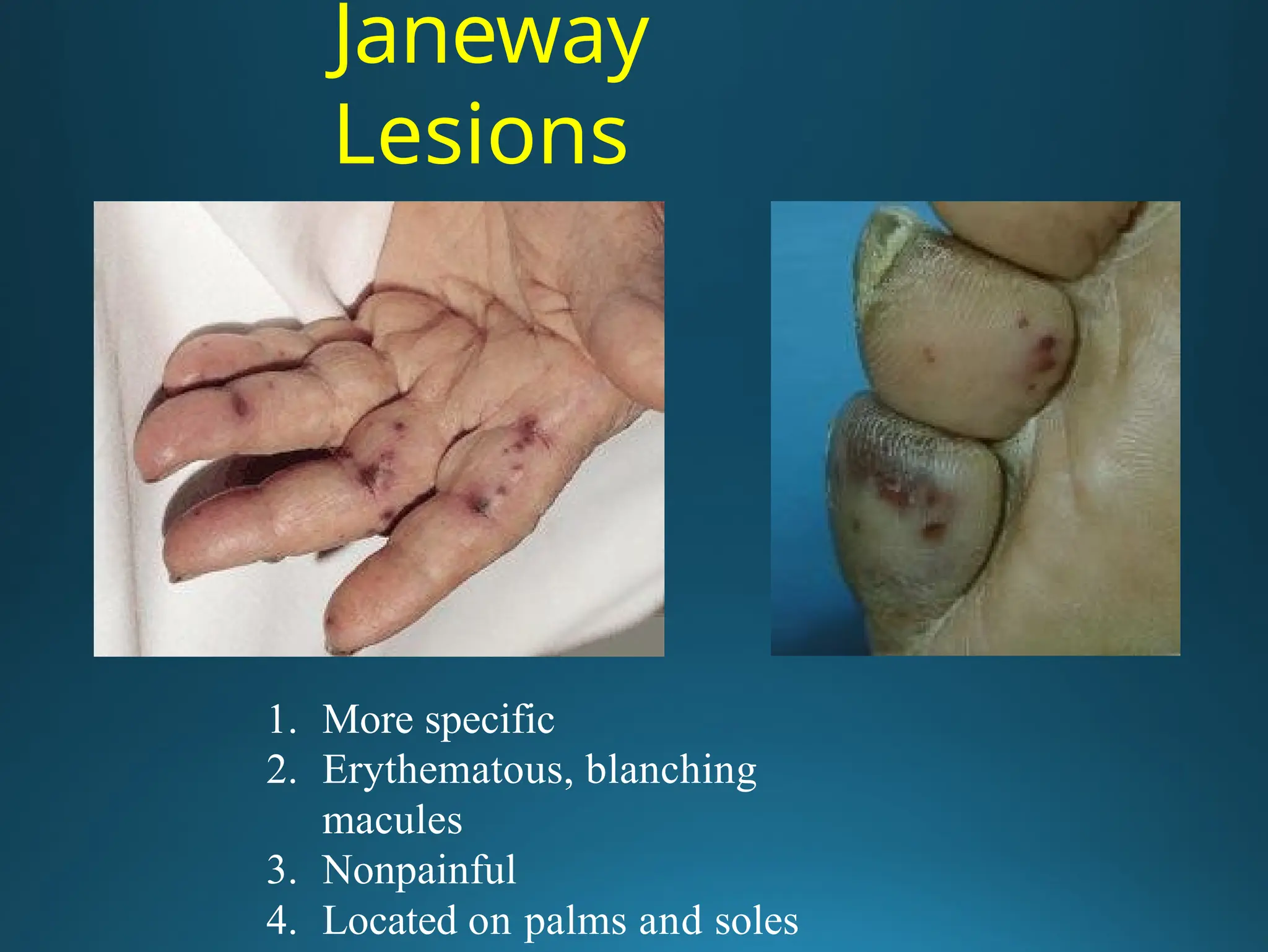 Infective endocarditis Endocrine Causes – Primary Aldosteronism ...