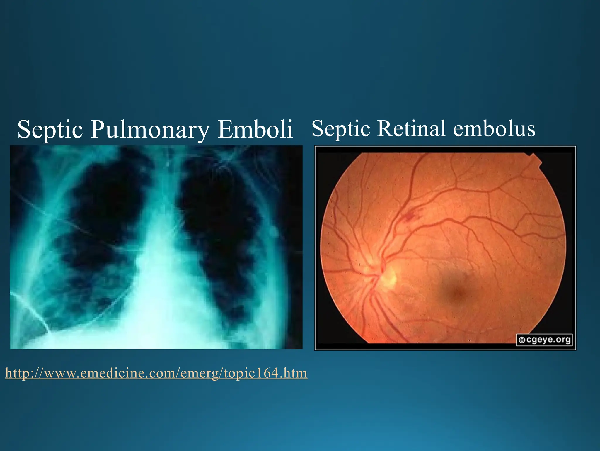 Infective endocarditis Endocrine Causes – Primary Aldosteronism ...
