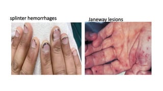 INFECTIVE ENDOCARDITIS PATHOPHYSIOGY DIAGNOSIS AND MANAGEMENT. | PPT