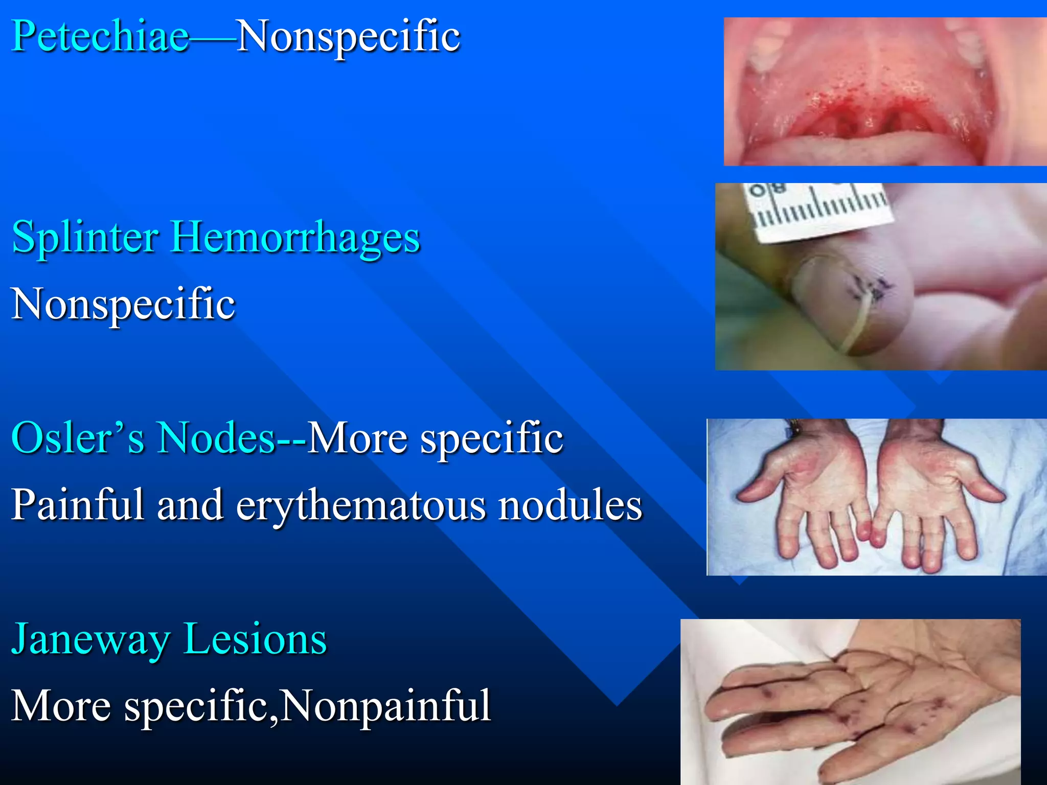 Infective endocarditis | PPT