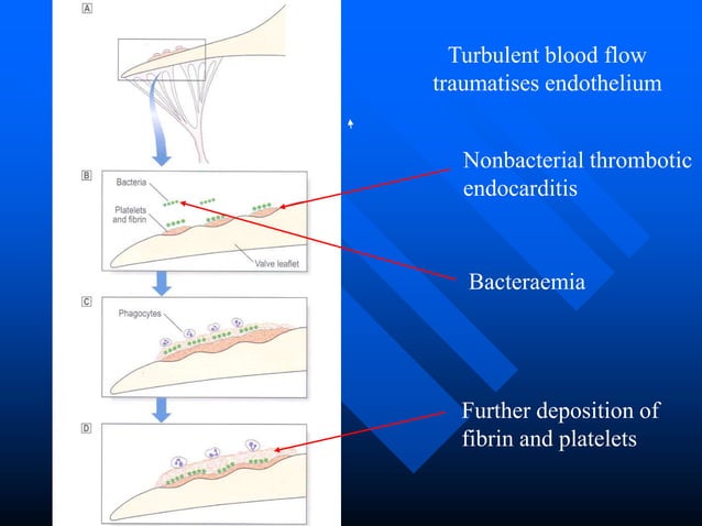 Infective endocarditis | PPT