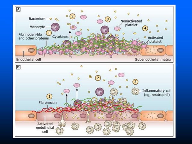 Infective endocarditis | PPT