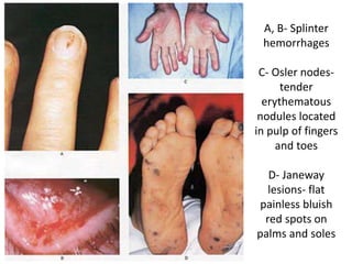 Infective endocarditis ug- 23 feb 2017 | PPT