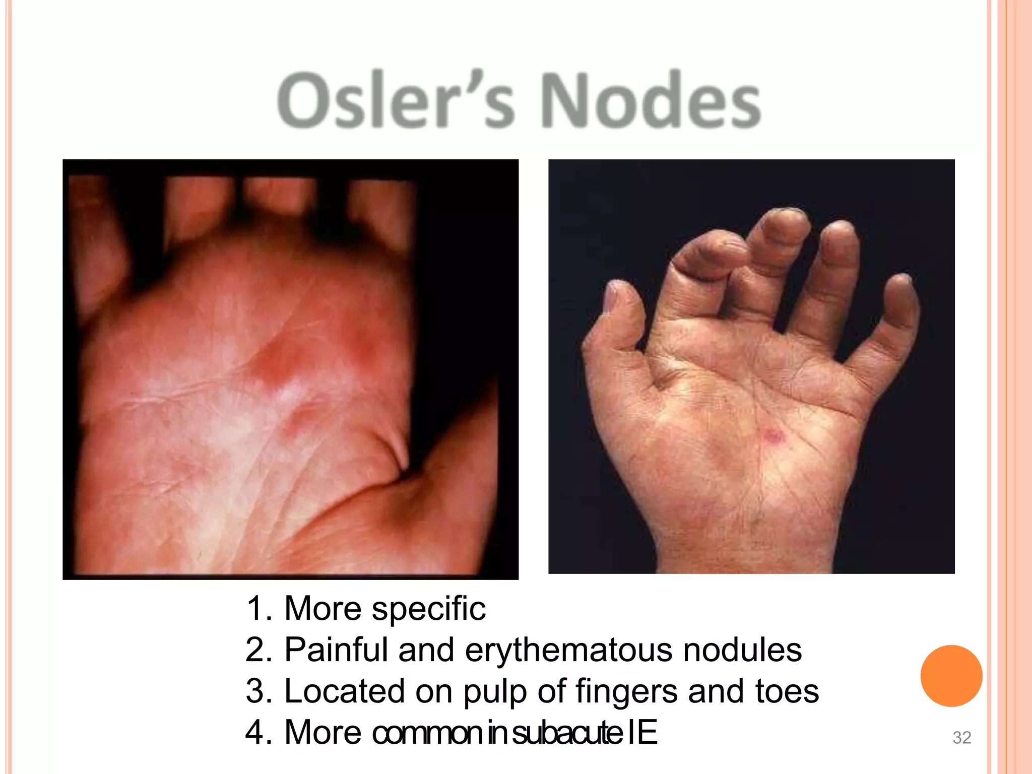 Infective endocarditis | PPT