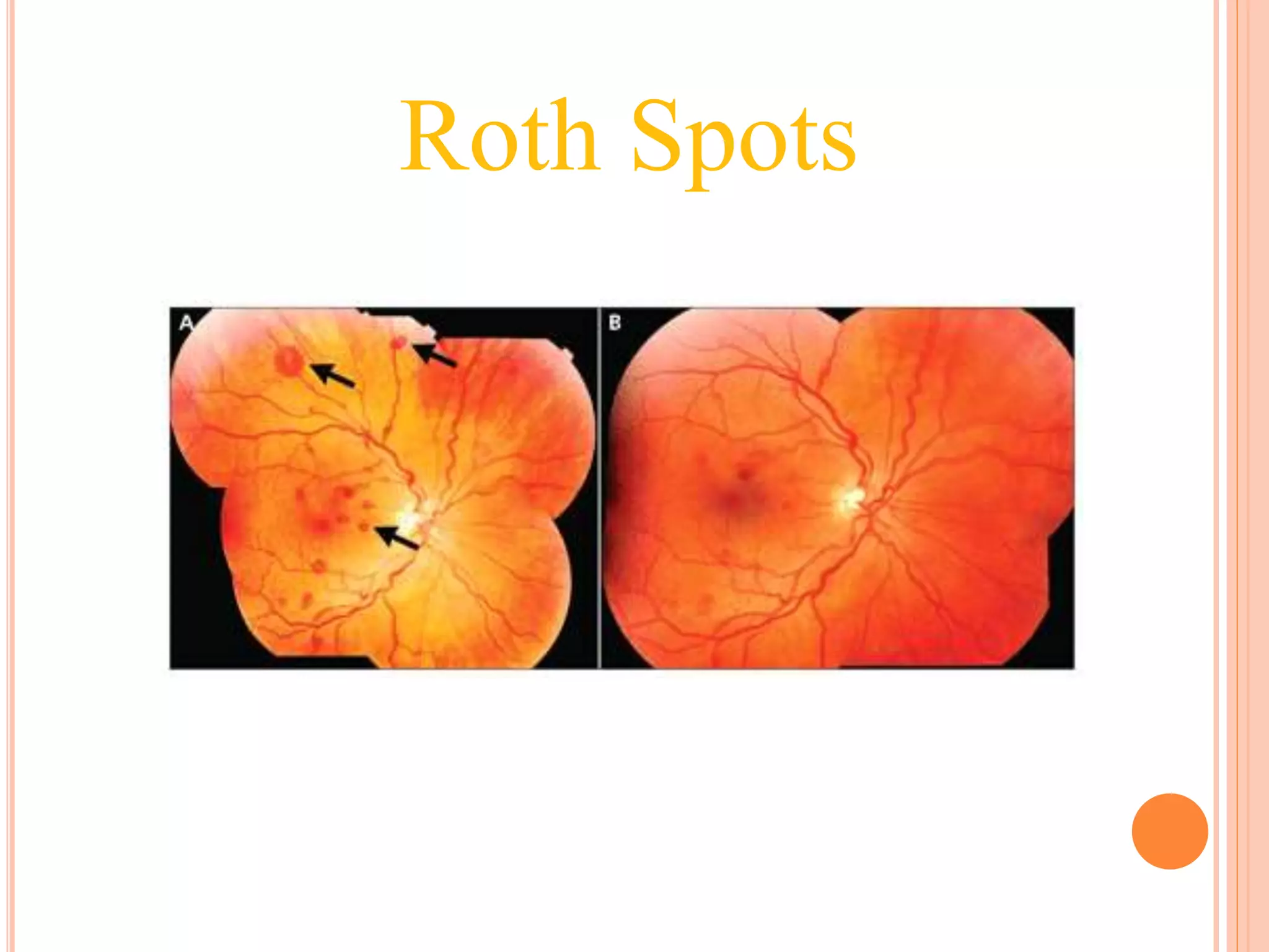 Infective endocarditis | PPT