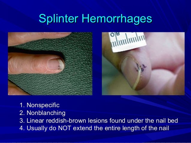 Infective endocarditis-1
