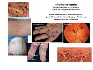 Infective Endocarditis in children (2).ppt