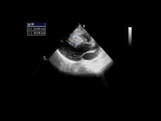 Infective Endocarditis Echo