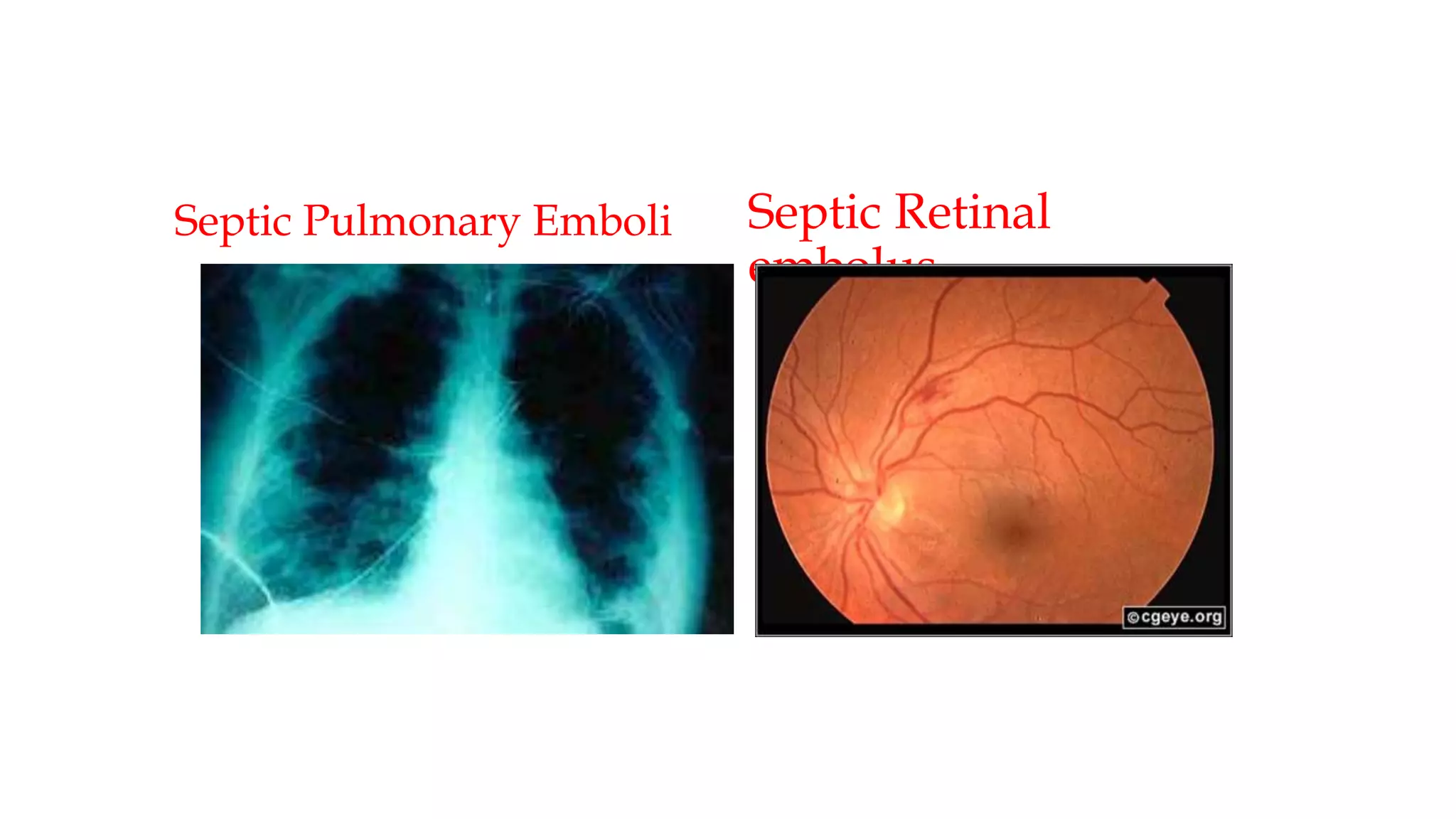 Infective endocarditis ESC guidelines Ahmed Yehia. MD | PPTX