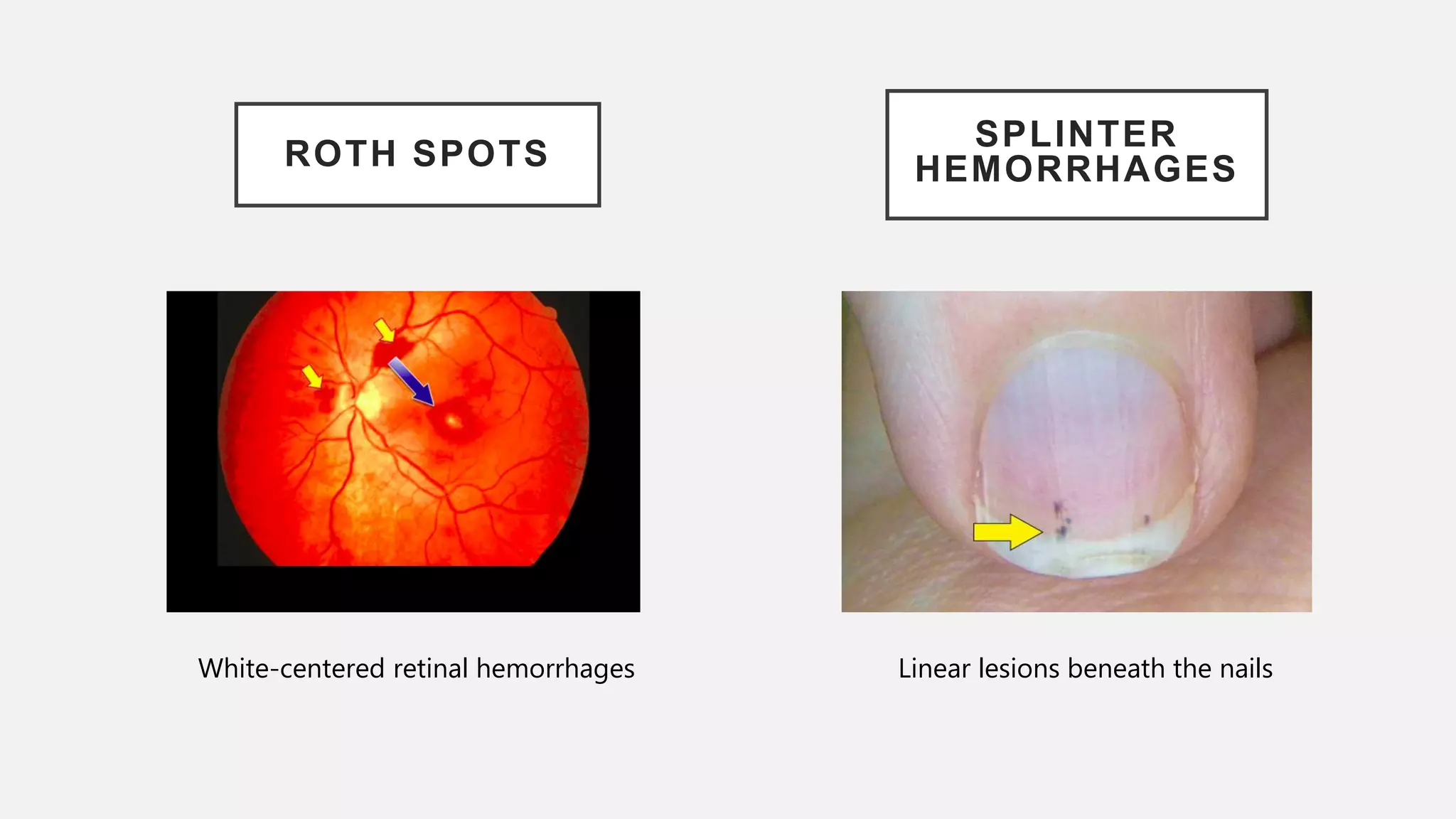Infective Endocarditis Pediatrics | PPTX