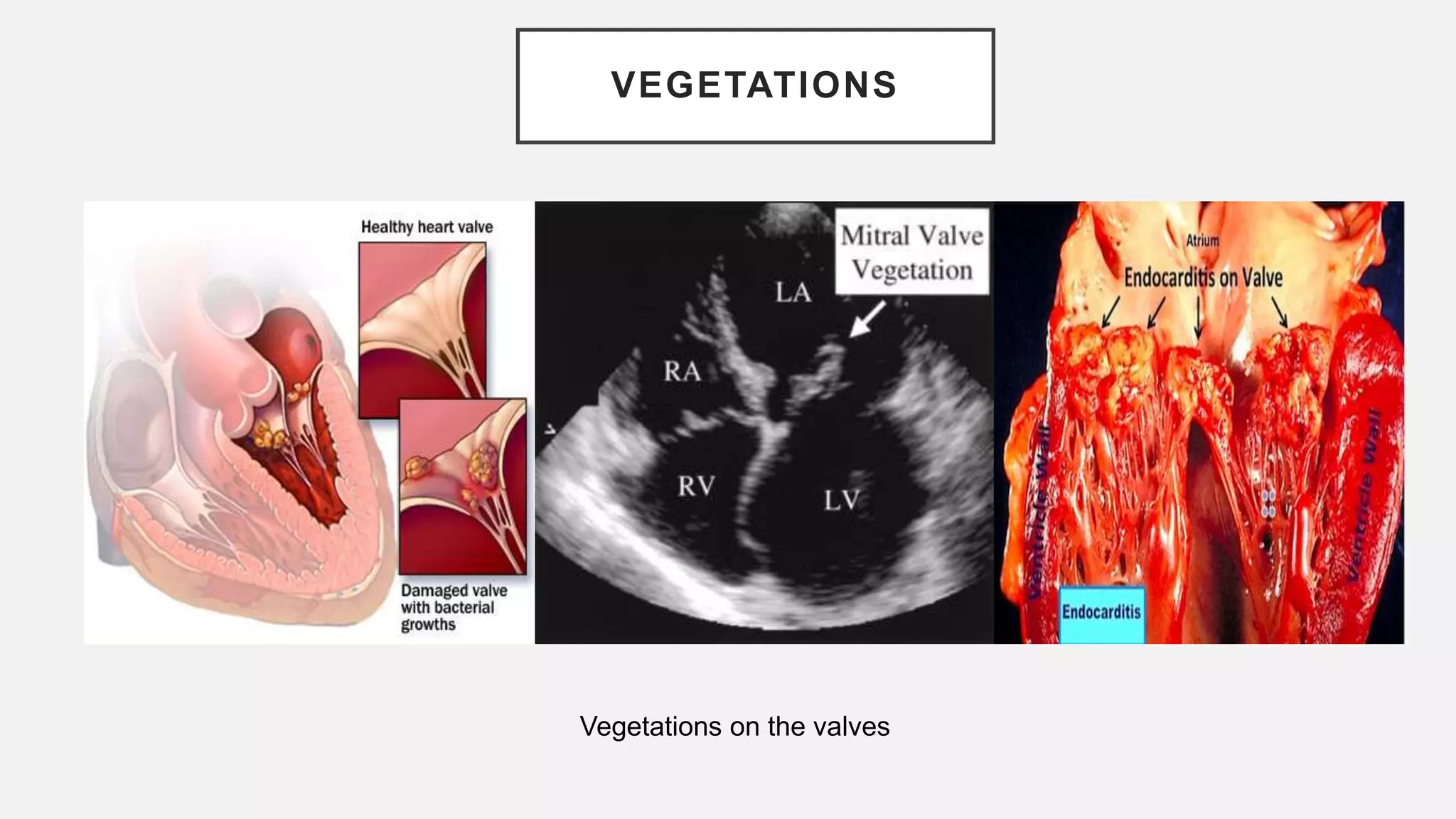 Infective Endocarditis Pediatrics | PPTX