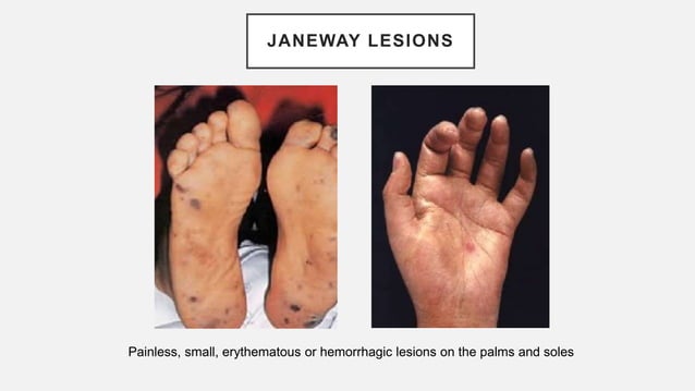 Infective Endocarditis Pediatrics | PPTX