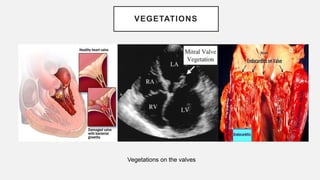 Infective Endocarditis Pediatrics | PPTX