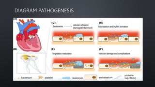 Infective endocarditis | PPTX