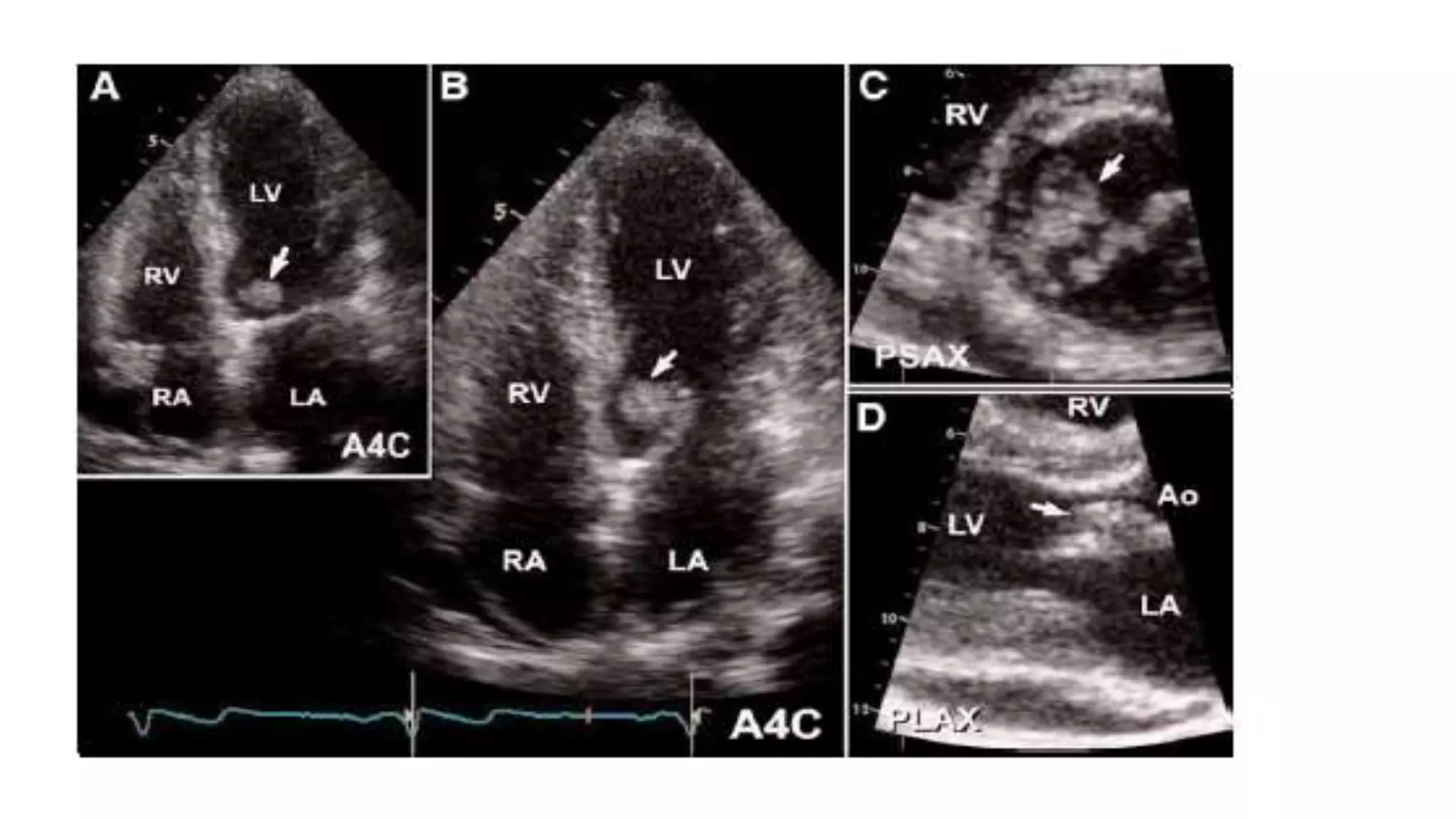 Infective endocarditis Echocardiography | PPTX