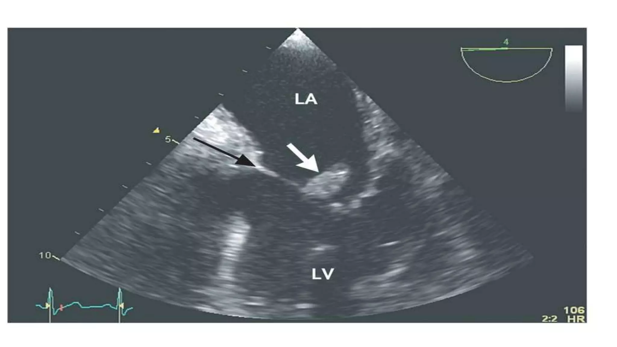 Infective endocarditis Echocardiography | PPTX