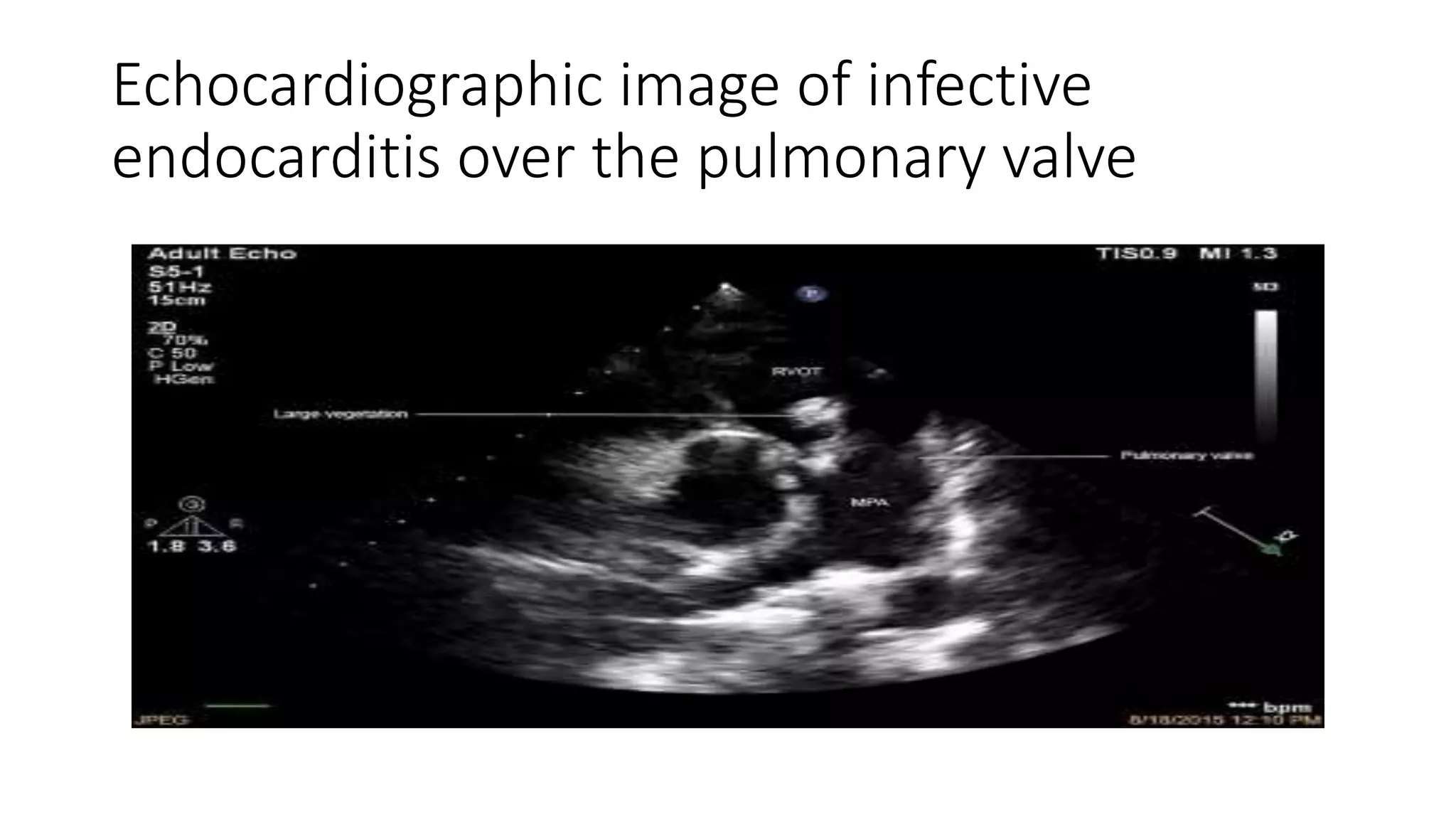 Infective endocarditis Echocardiography | PPTX