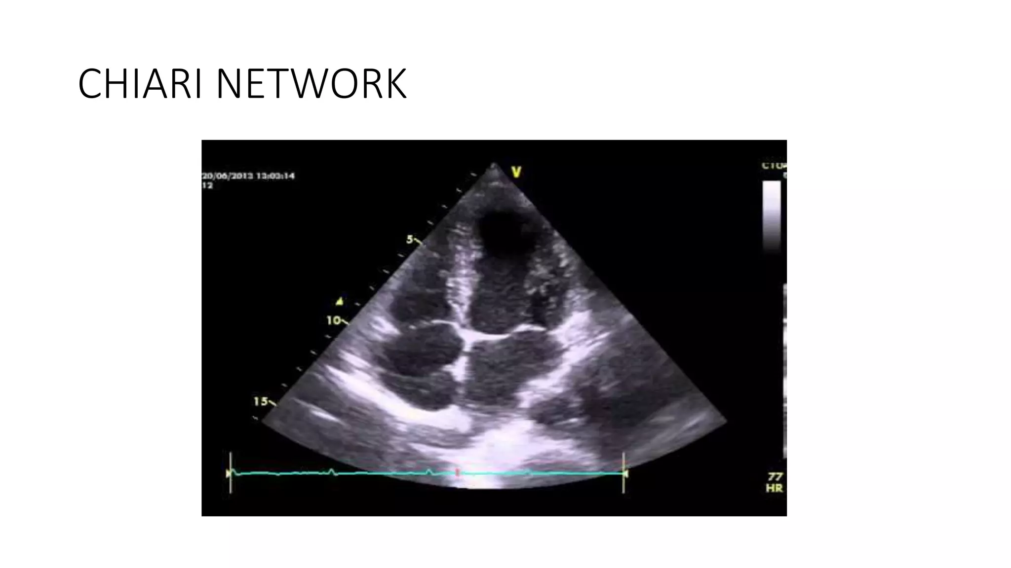Infective endocarditis Echocardiography | PPTX