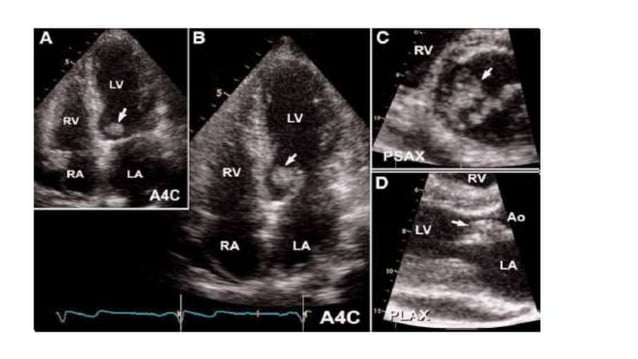 Infective endocarditis Echocardiography | PPTX | Heart and ...