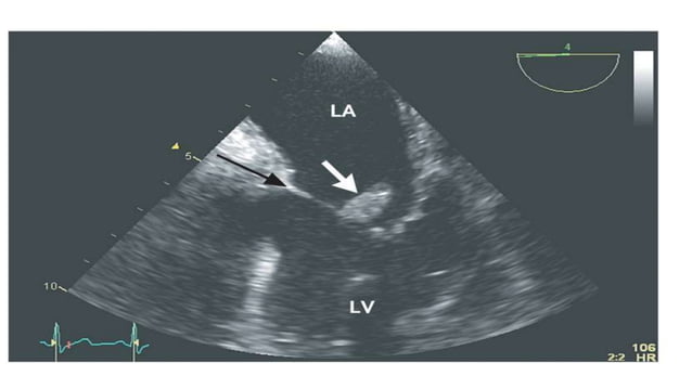 Infective endocarditis Echocardiography | PPTX | Heart and ...