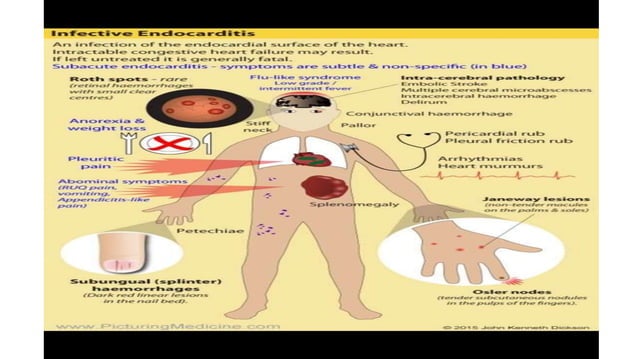 Infective endocarditis Echocardiography | PPTX | Heart and ...