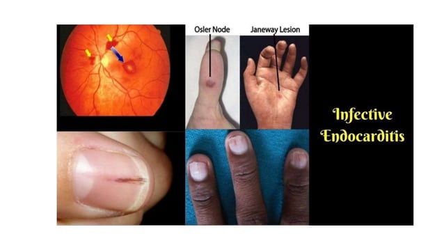 Infective endocarditis Echocardiography | PPTX | Heart and ...