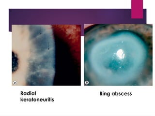 infective keratitis by Shazia khan. Pptx | PPTX