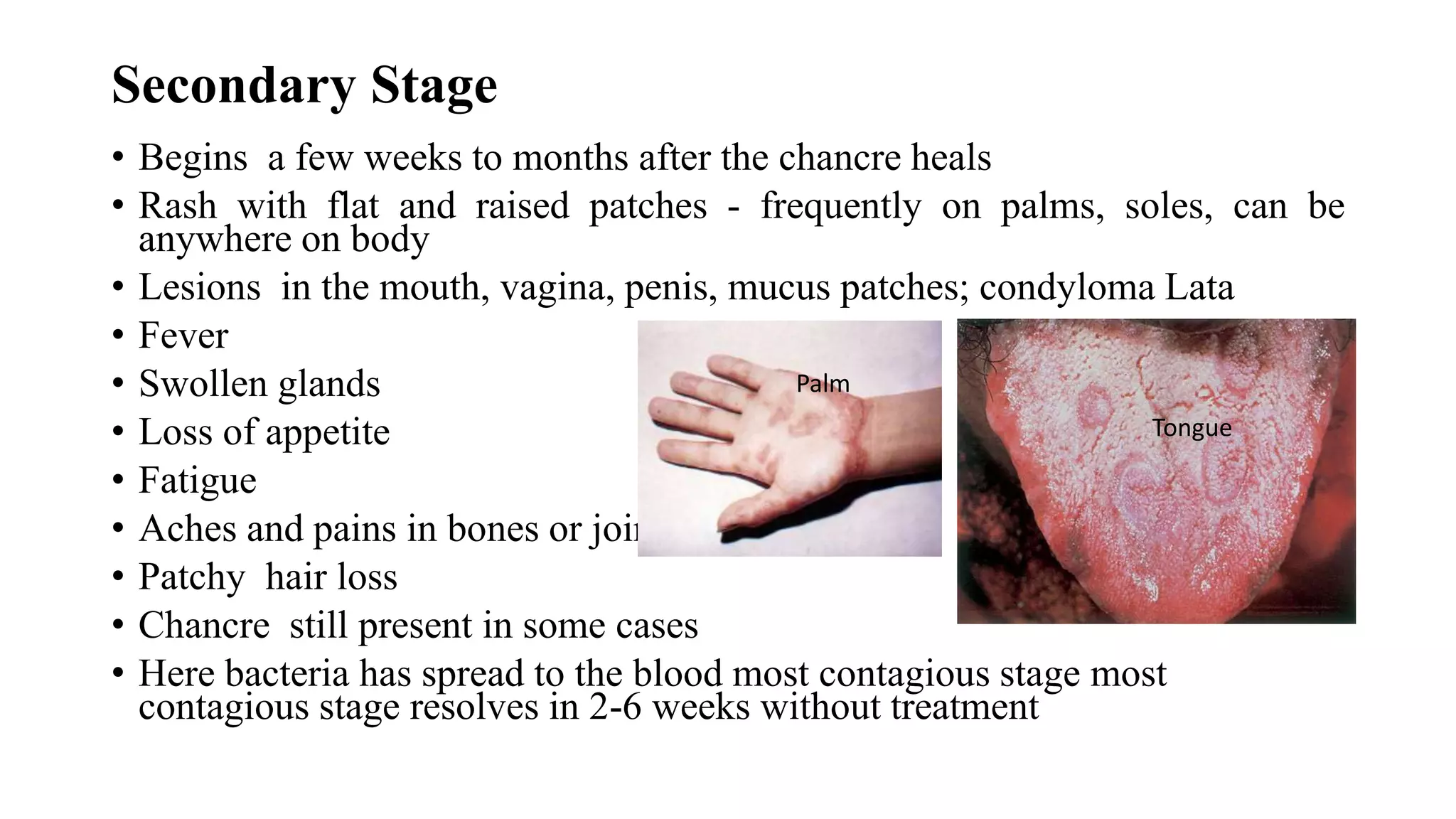 Infective stomatitis | PPTX