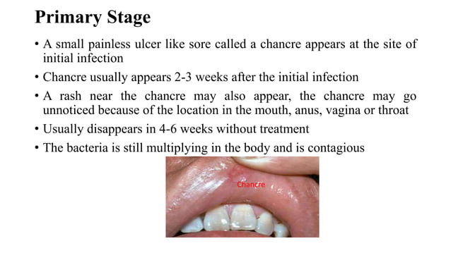 Infective stomatitis | PPTX