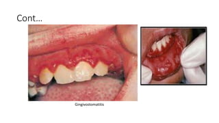 Infective stomatitis | PPTX