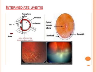 INFECTIVE UVEITIS-SEMINAR.pptx