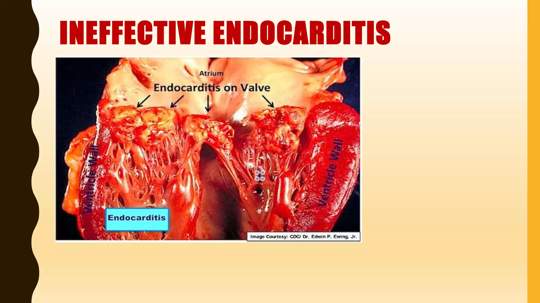 Endocarditis ( Inflammatory disease of the Heart | PPT