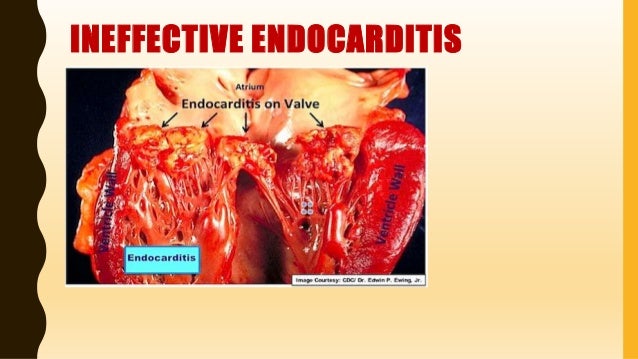 Endocarditis ( Inflammatory disease of the Heart