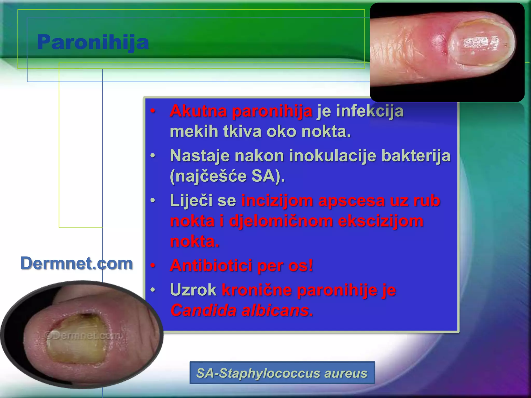 Infekcije na šaci | PPSX