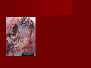 mengenali ims dan pencegahan terhadap penularan.ppt