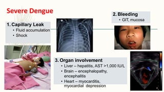 Infeksi dengue anak dan remaja update (1).pptx