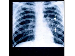 Infeksi jamur pada paru 3 | PPTX | Infectious Diseases | Diseases and ...
