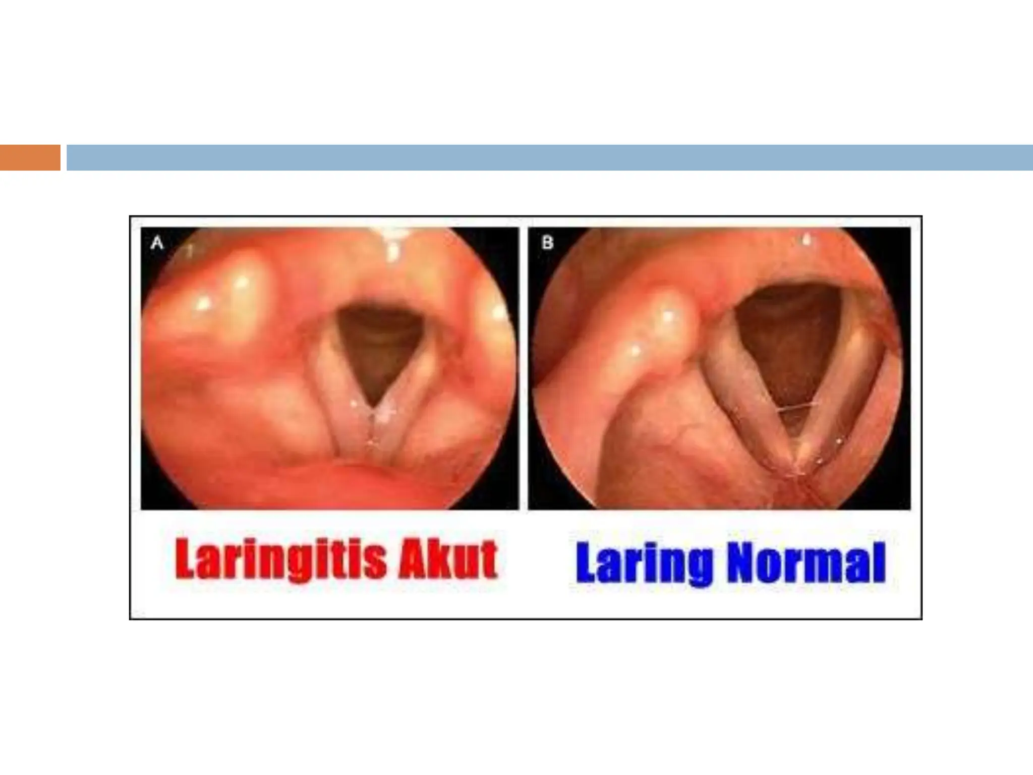 infeksi laring baru adalah bahan kuliah untuk residen.pptx