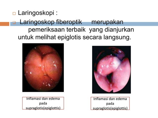 infeksi laring baru adalah bahan kuliah untuk residen.pptx