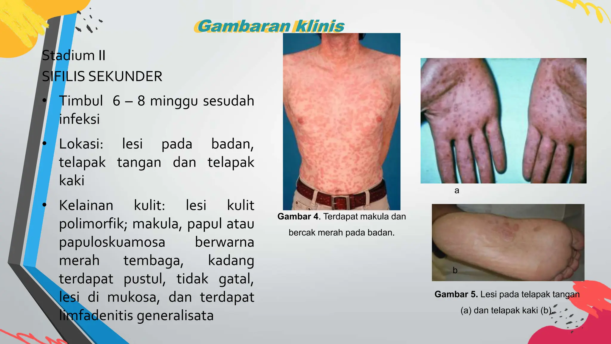 Macam macam Infeksi menular seksual (IMS) | PPTX