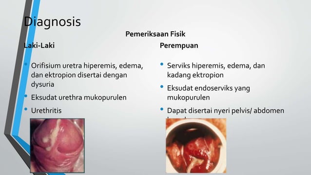 Macam macam Infeksi menular seksual (IMS) | PPTX