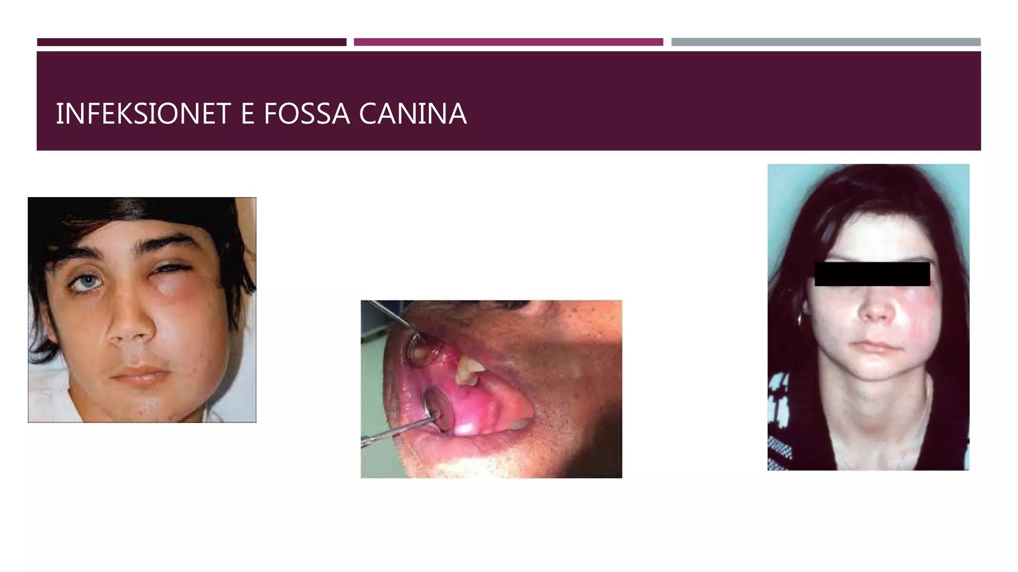 Infeksioni i fossa canina shqip - ideal sallauka | PPTX