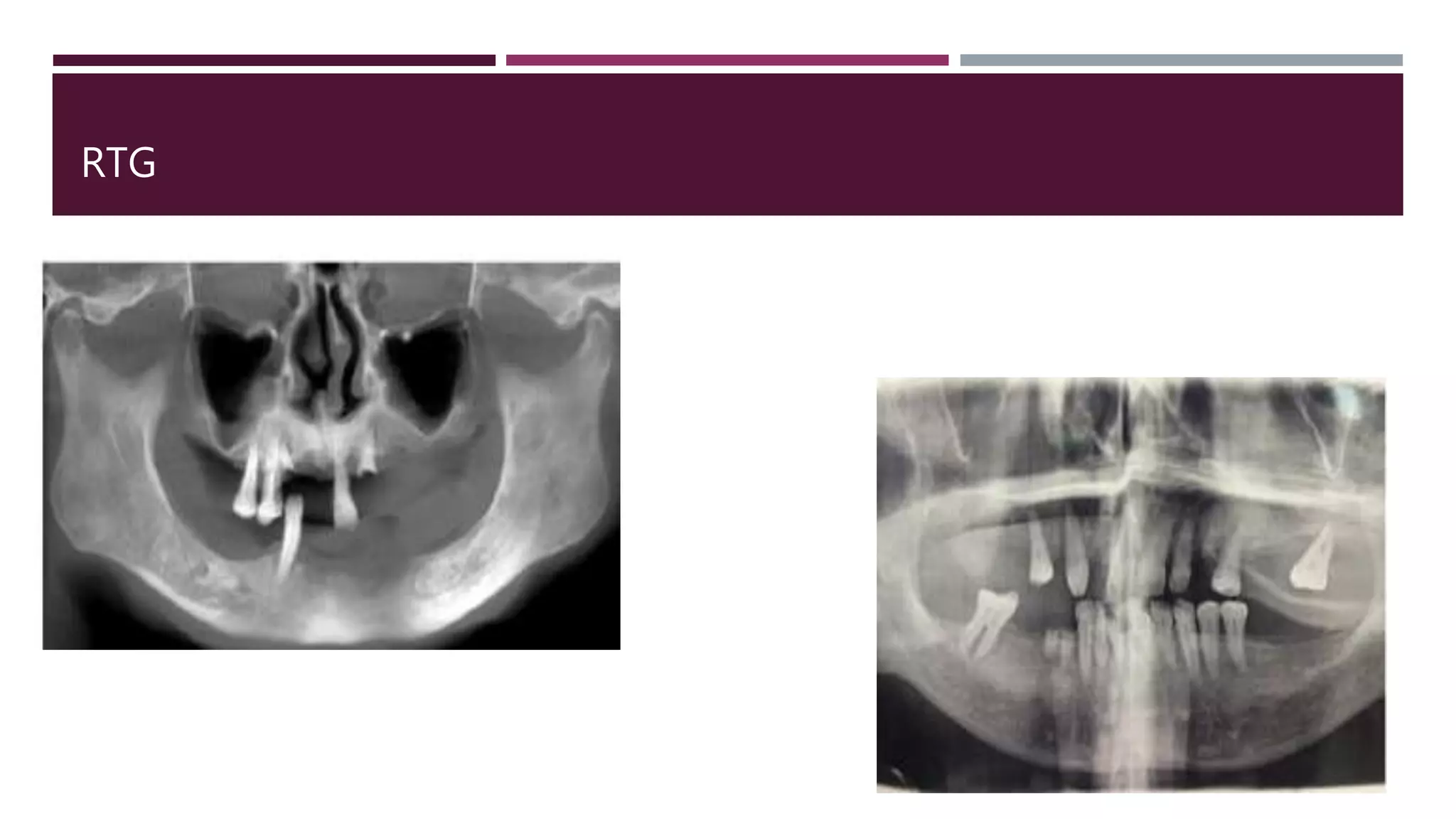 Infeksioni i fossa canina shqip - ideal sallauka | PPTX