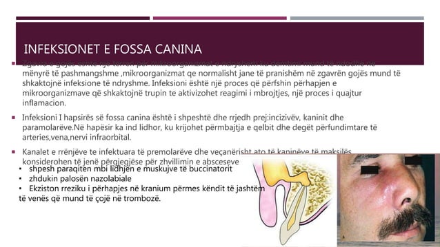 Infeksioni i fossa canina shqip - ideal sallauka | PPT