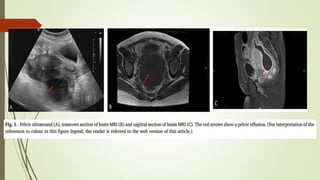 INFEKSI PANGGUL YANG DISEBABKAN OLEH PERIODONTITIS (1).pptx