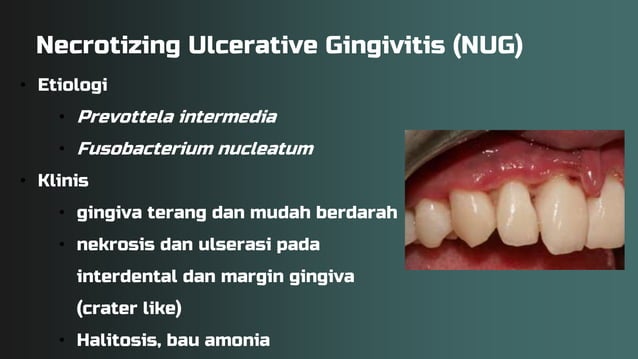 Infeksi Rongga Mulut di kepala leher.pptx