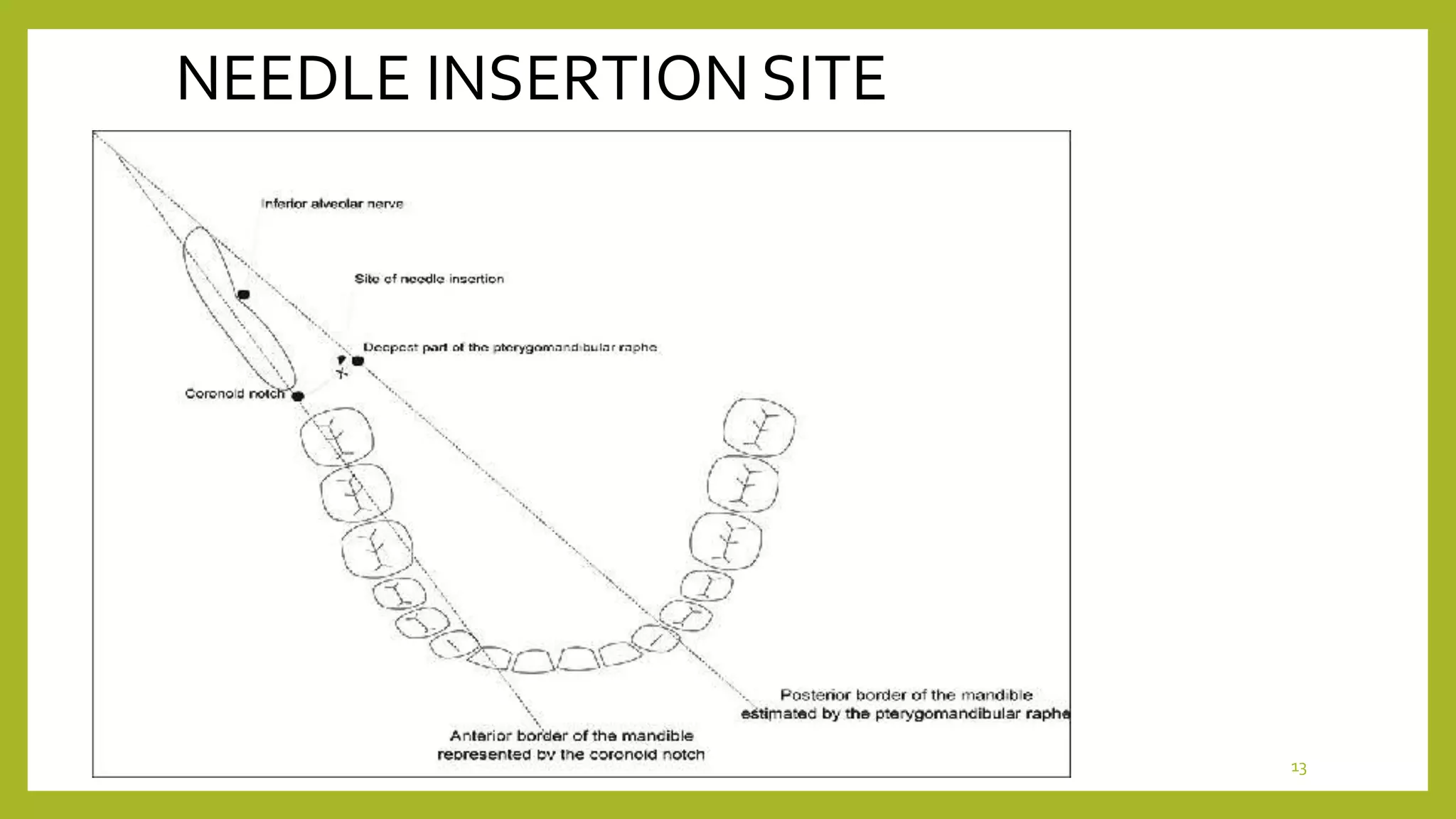 Inferior alveolar nerve | PPTX