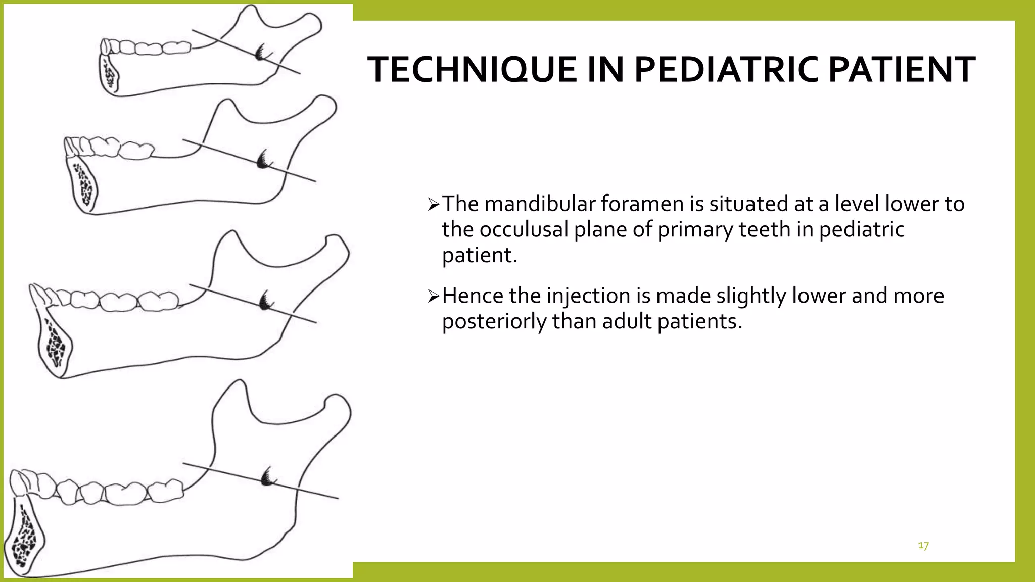 Inferior alveolar nerve | PPTX